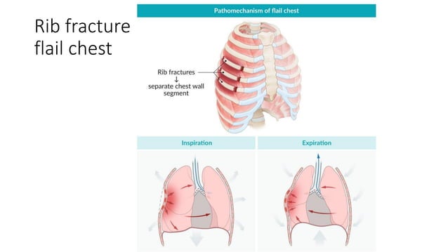 Chest Wall Surgery, Indications, Diagnosis, Management | PDF