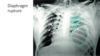Chest Wall Surgery, Indications, Diagnosis, Management | PDF