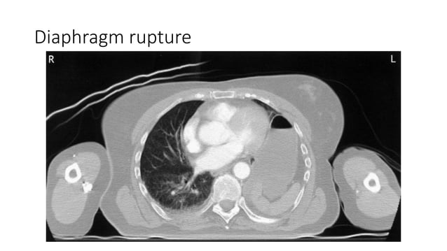 Chest Wall Surgery, Indications, Diagnosis, Management | PDF