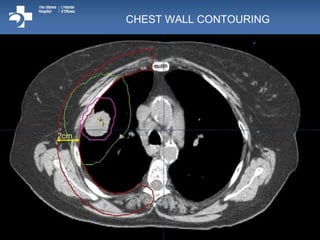 CHEST WALL TOXICITY IN SABR : PREDICTORS AND CONTOURING OF CHEST WALL | PPT