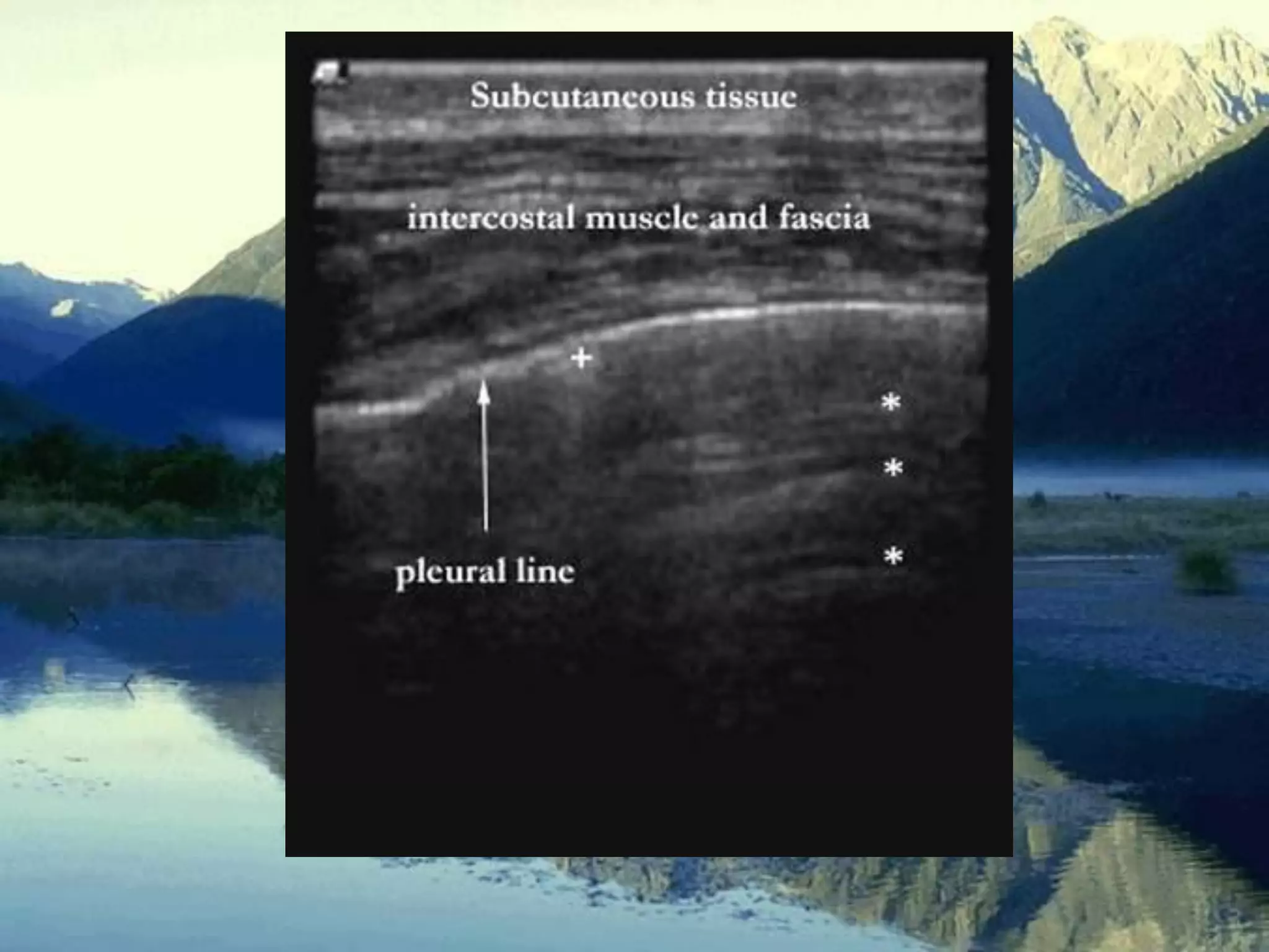 Chest Wall Ultrasound | PDF
