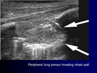 Chest Wall Ultrasound | PDF