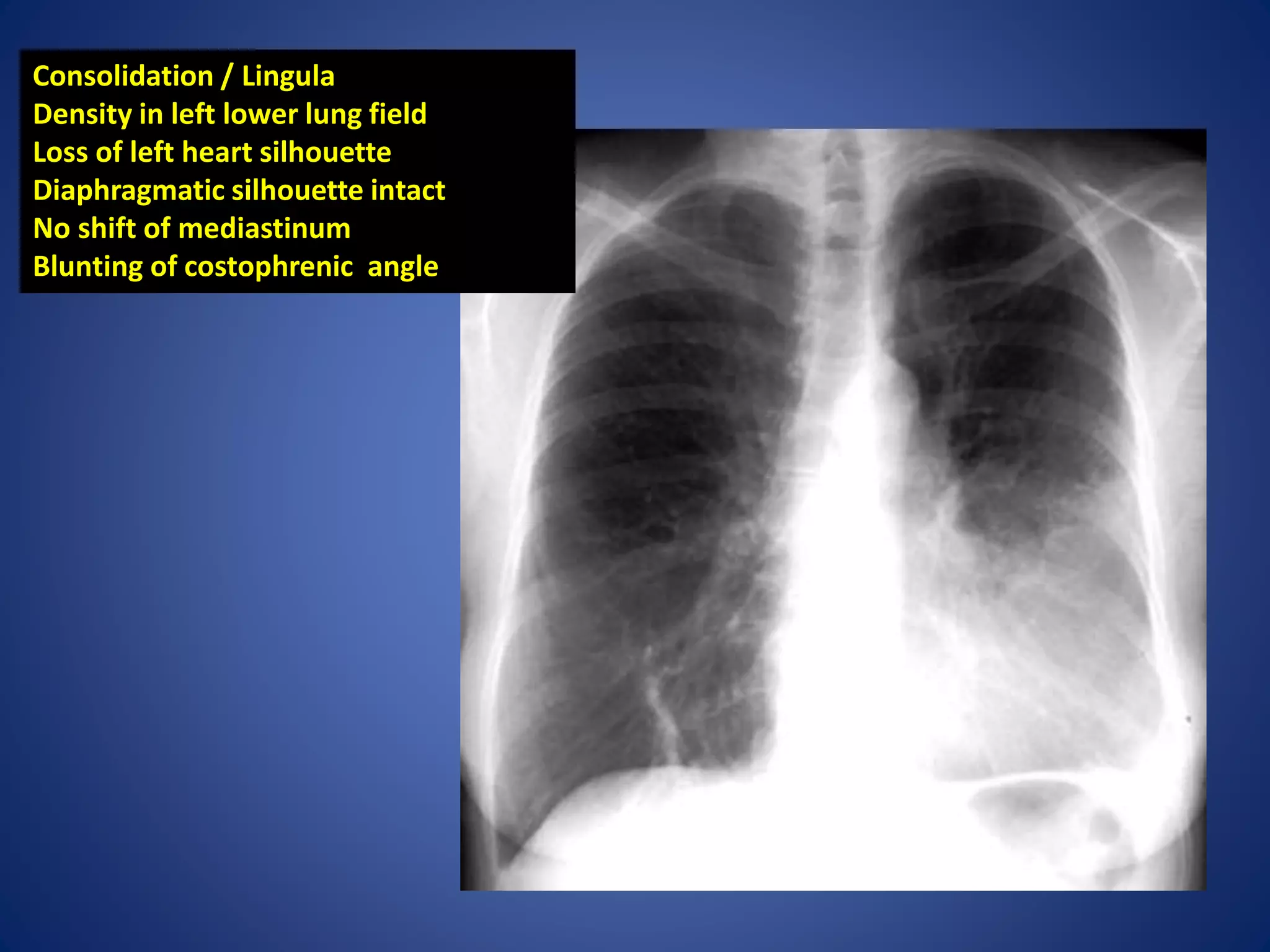 Chest x. ray interpretation and teaching | PPTX