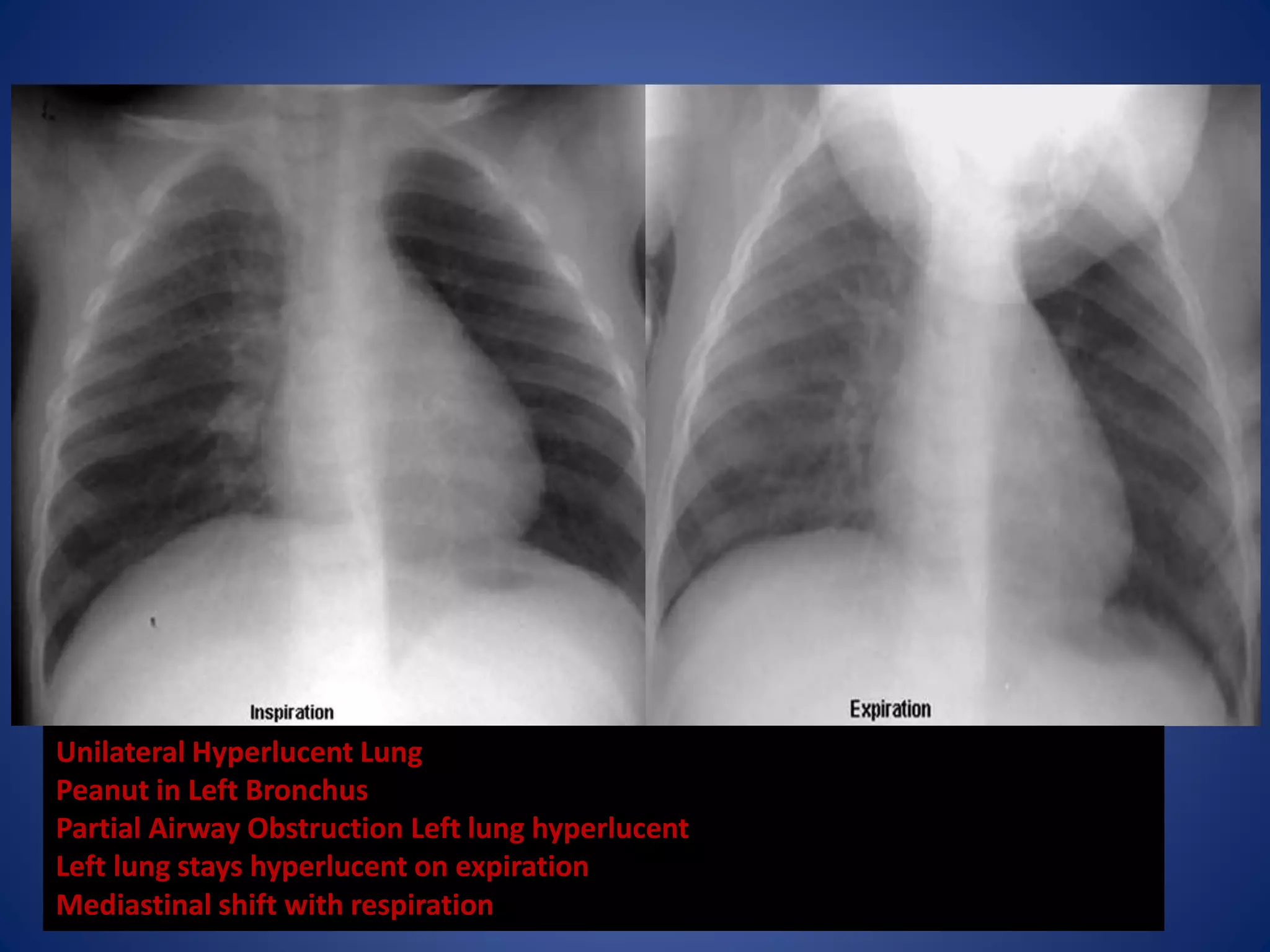 Chest x. ray interpretation and teaching | PPTX