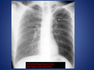 Chest x. ray interpretation and teaching | PPTX