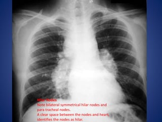 Chest x. ray interpretation and teaching | PPTX