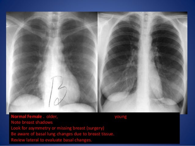 Normal Chest X Ray Female