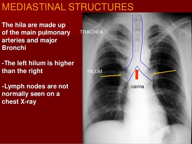 Chest x ray