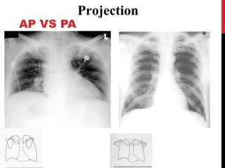 Chest x ray | PPT