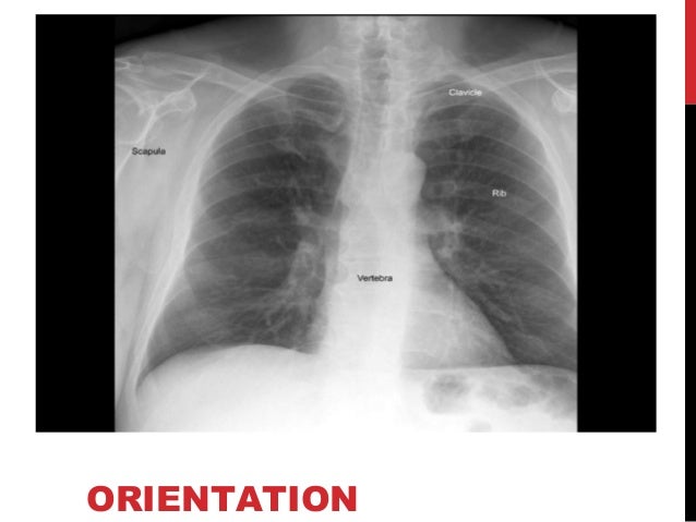 Lateral Chest X Ray Rotation