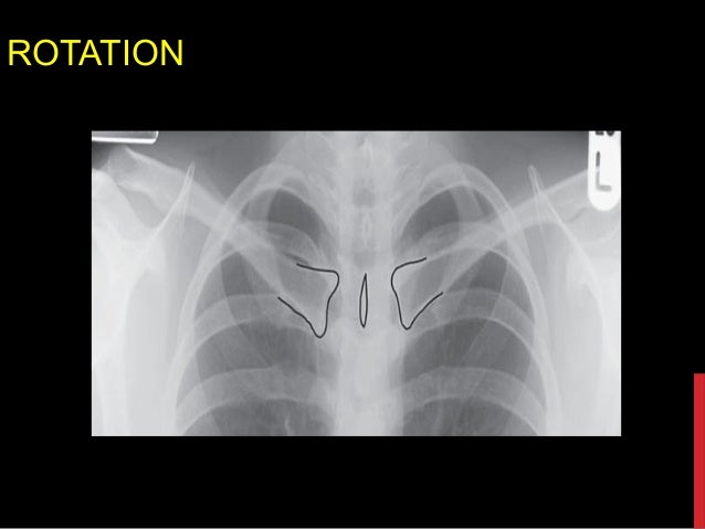 Chest x ray
