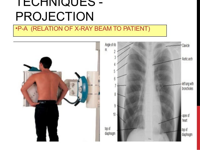 Chest x ray