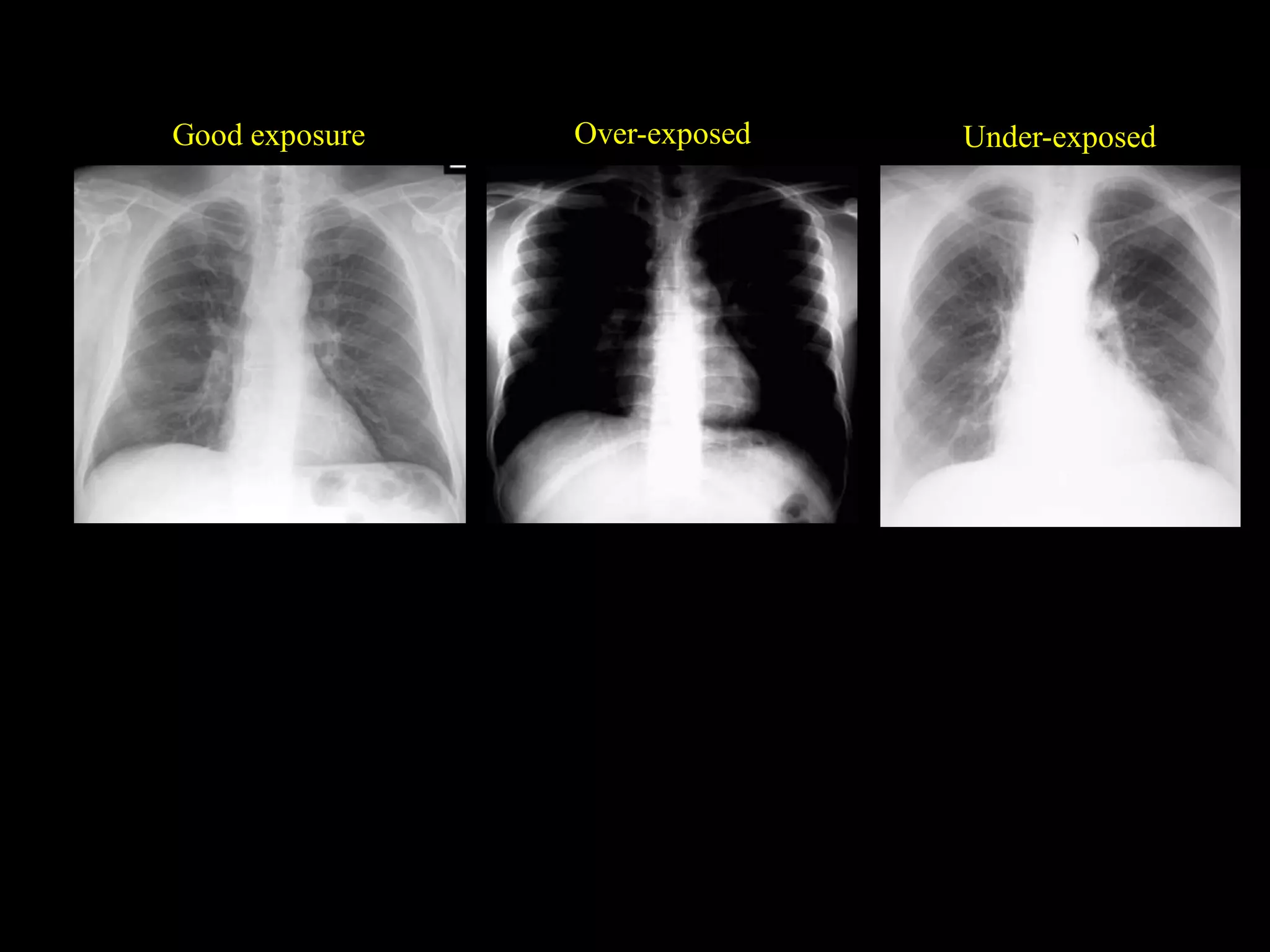 Chest X-ray Interpretation | PDF