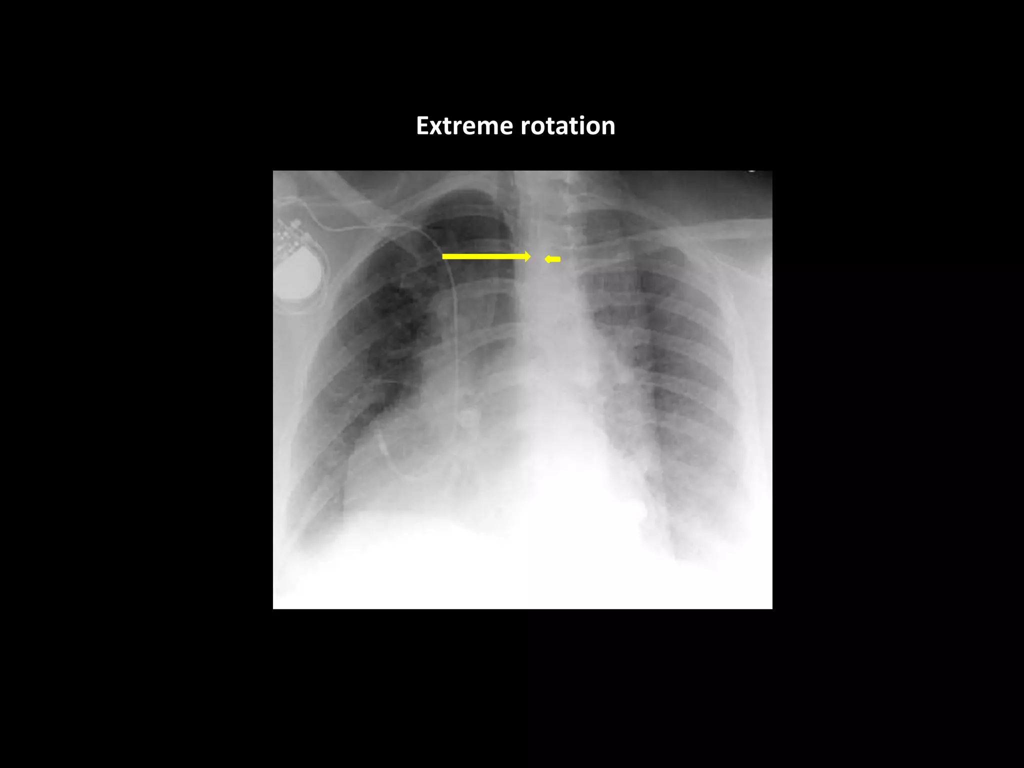 Chest X-ray Interpretation | PDF