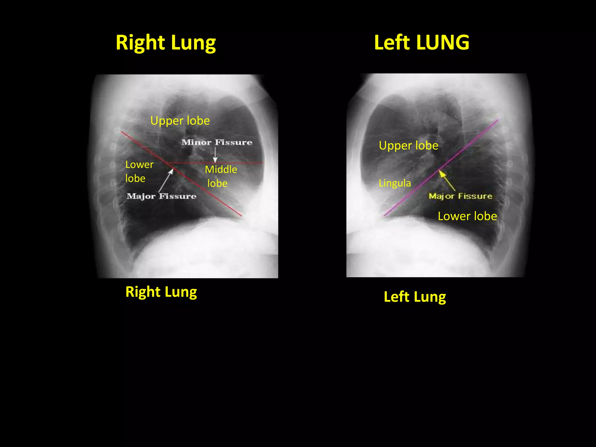 Chest X-ray Interpretation | PDF