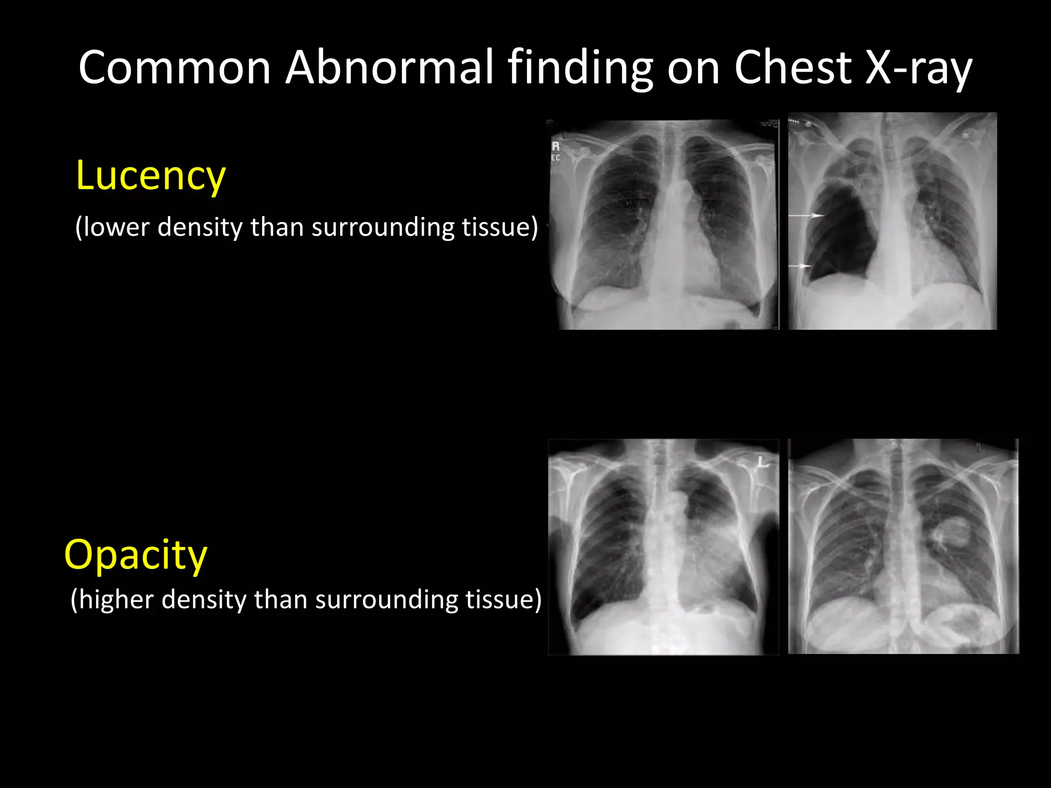 Chest X-ray Interpretation | PDF