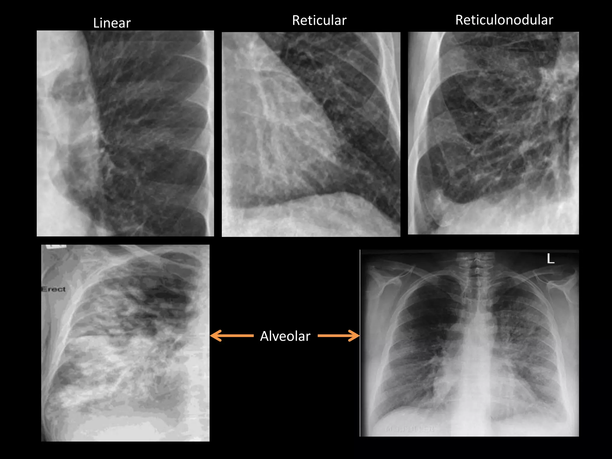 Chest X-ray Interpretation | PDF