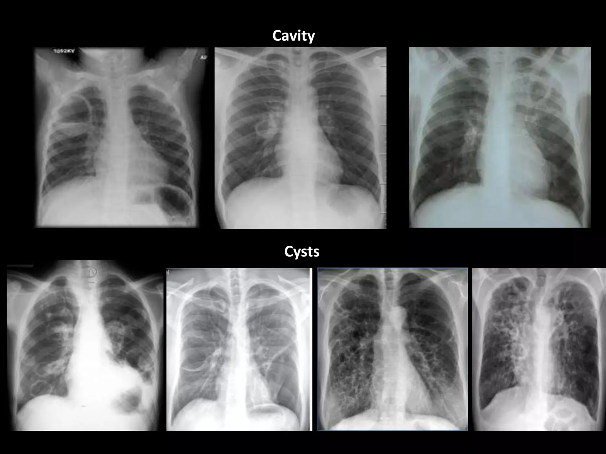 Chest X-ray Interpretation | PDF