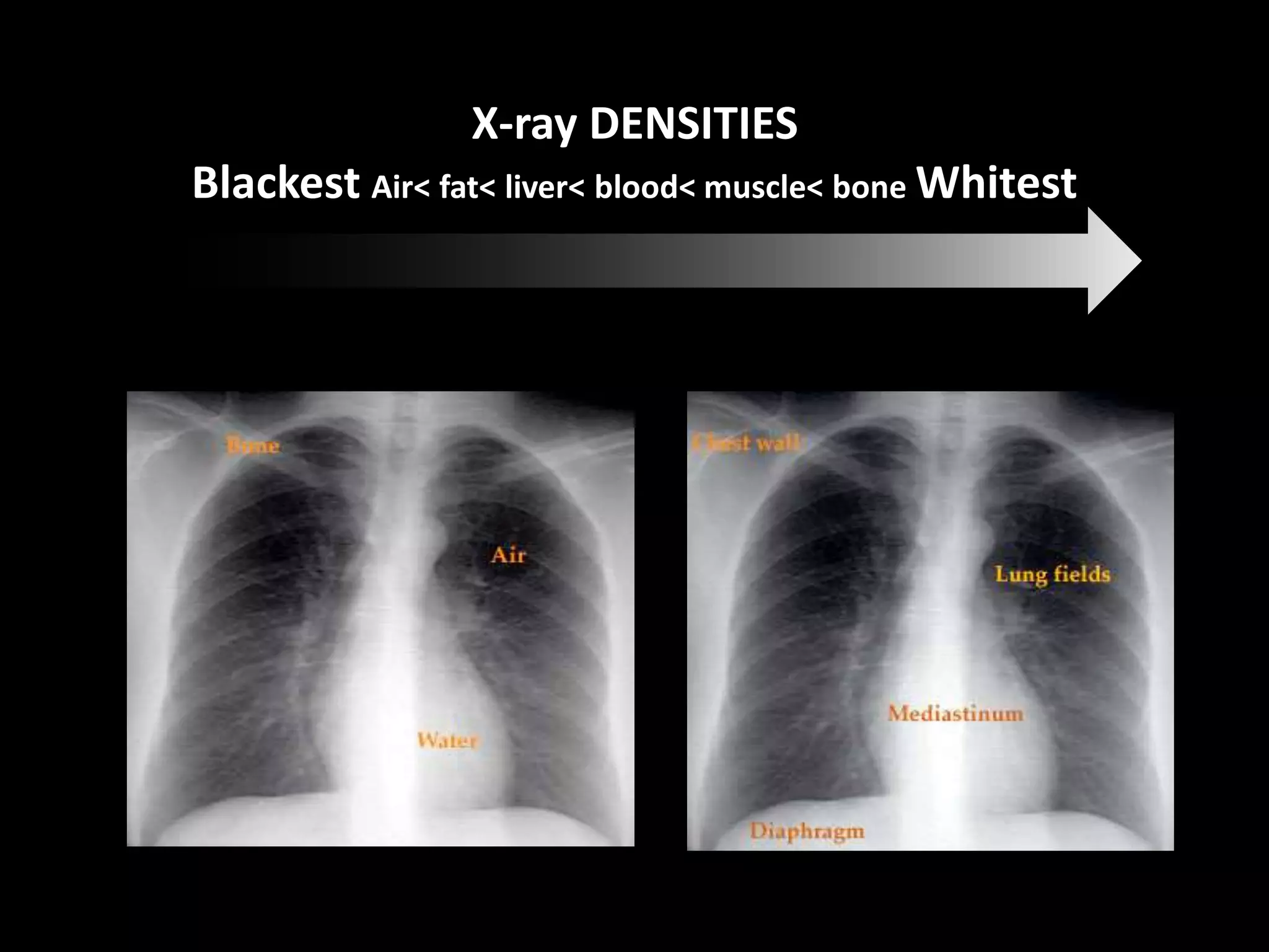 Chest X-ray Interpretation | PDF