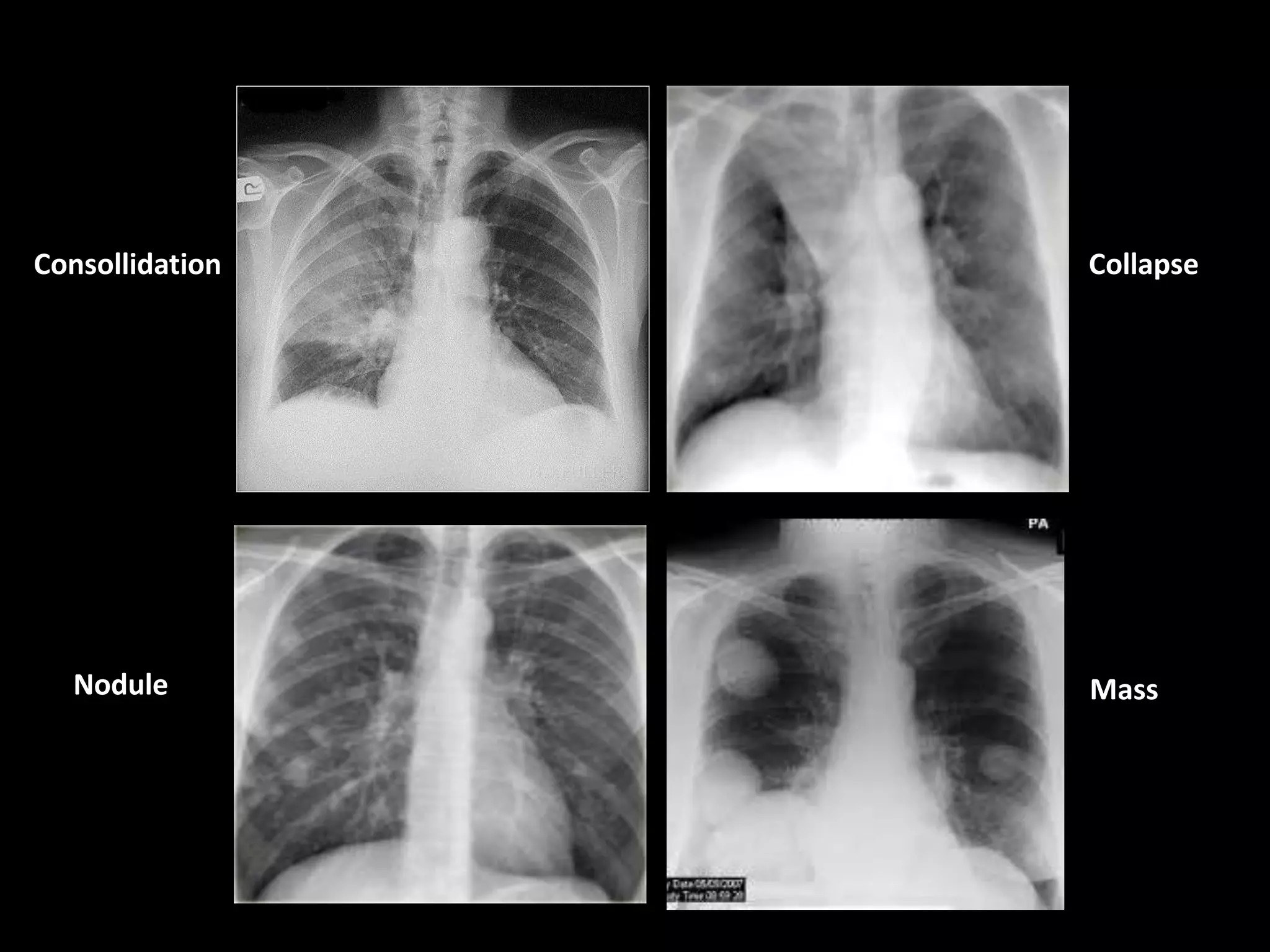 Chest X-ray Interpretation | PDF