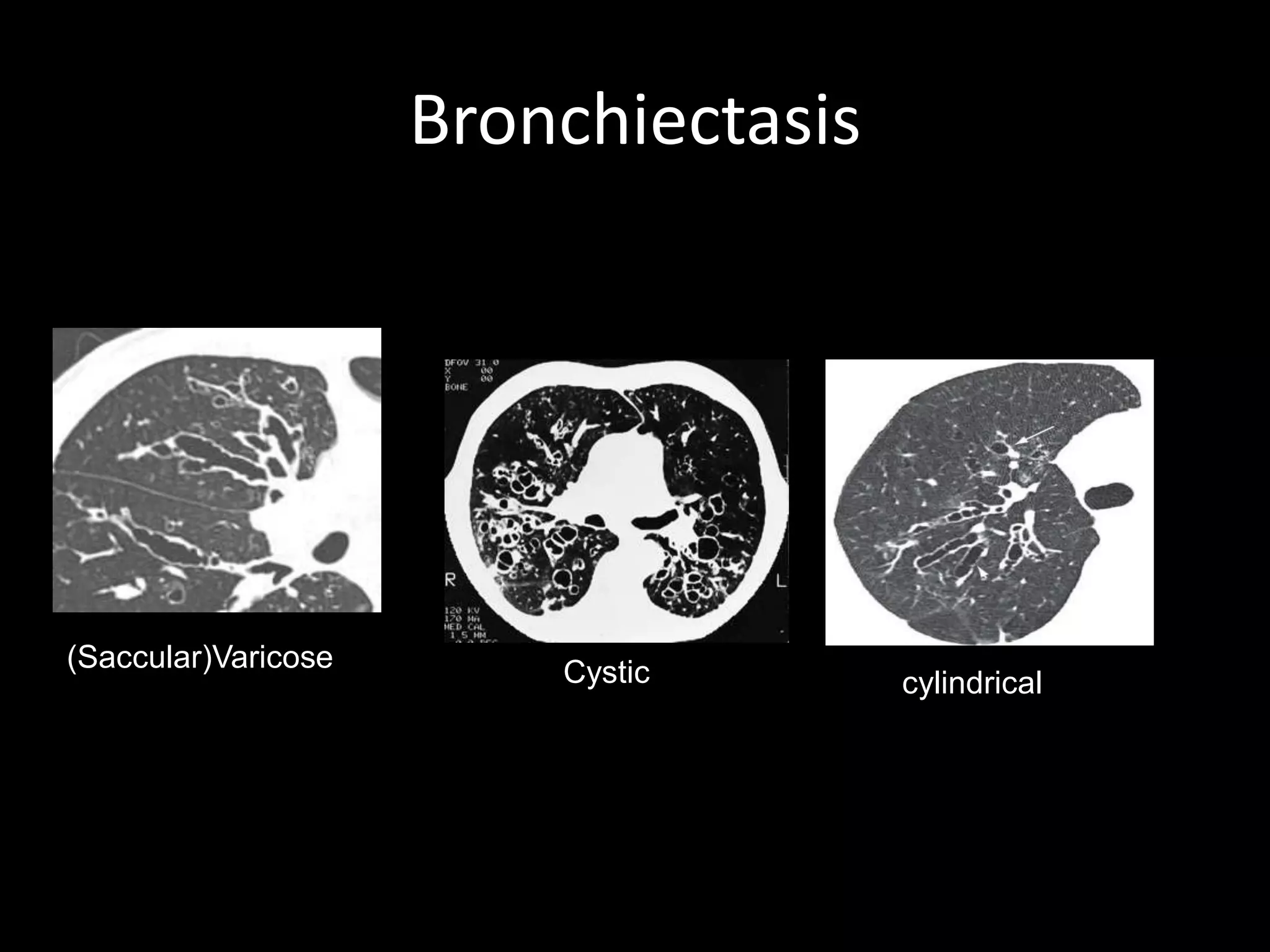 Chest X-ray Interpretation | PDF
