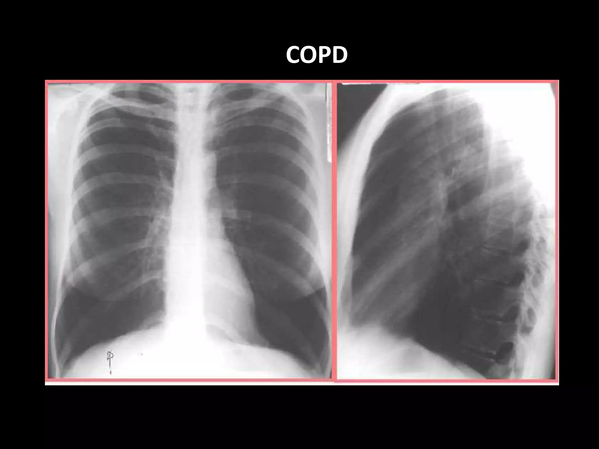 Chest X ray Interpretation PDF