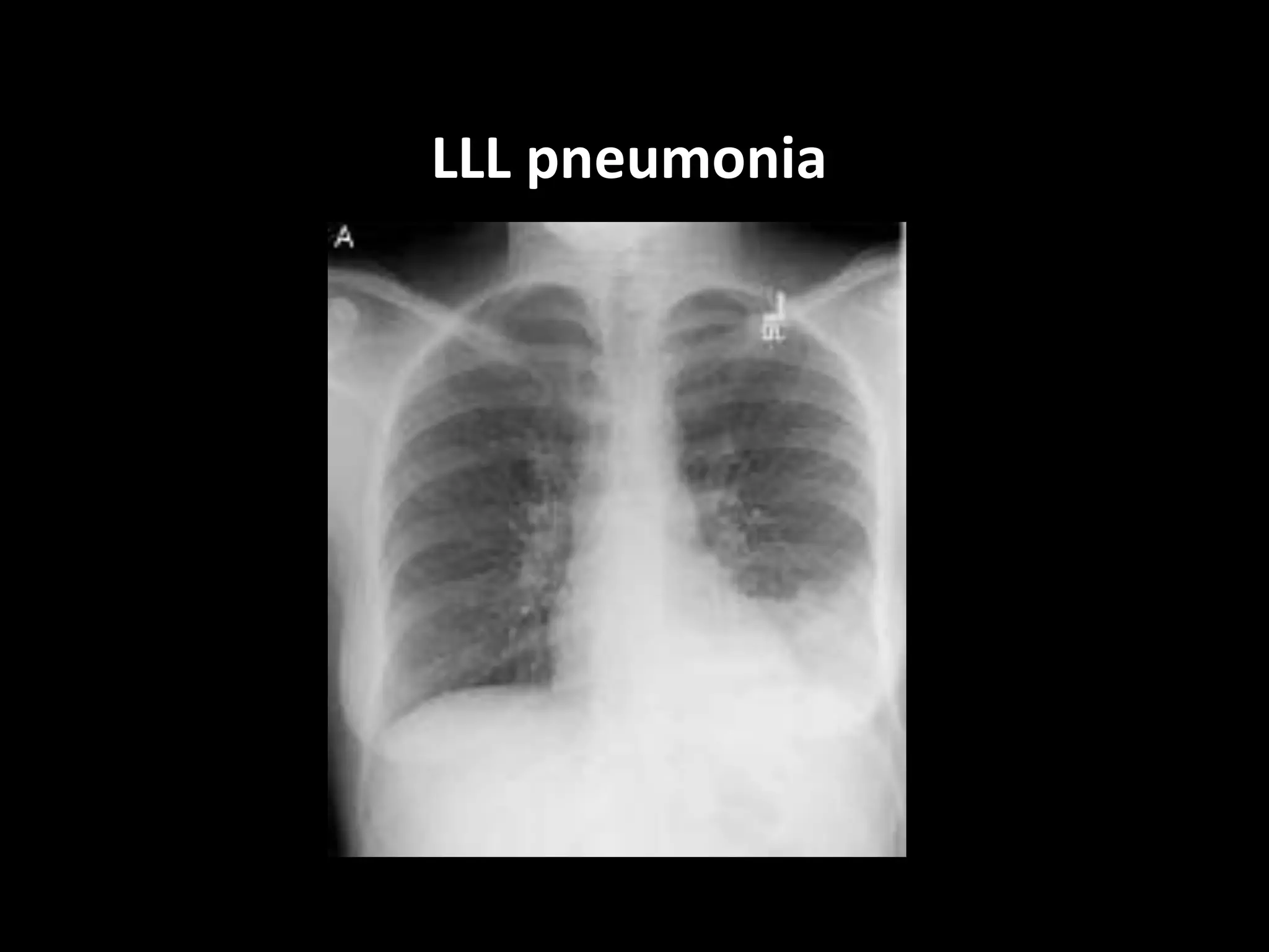 Chest X-ray Interpretation | PDF
