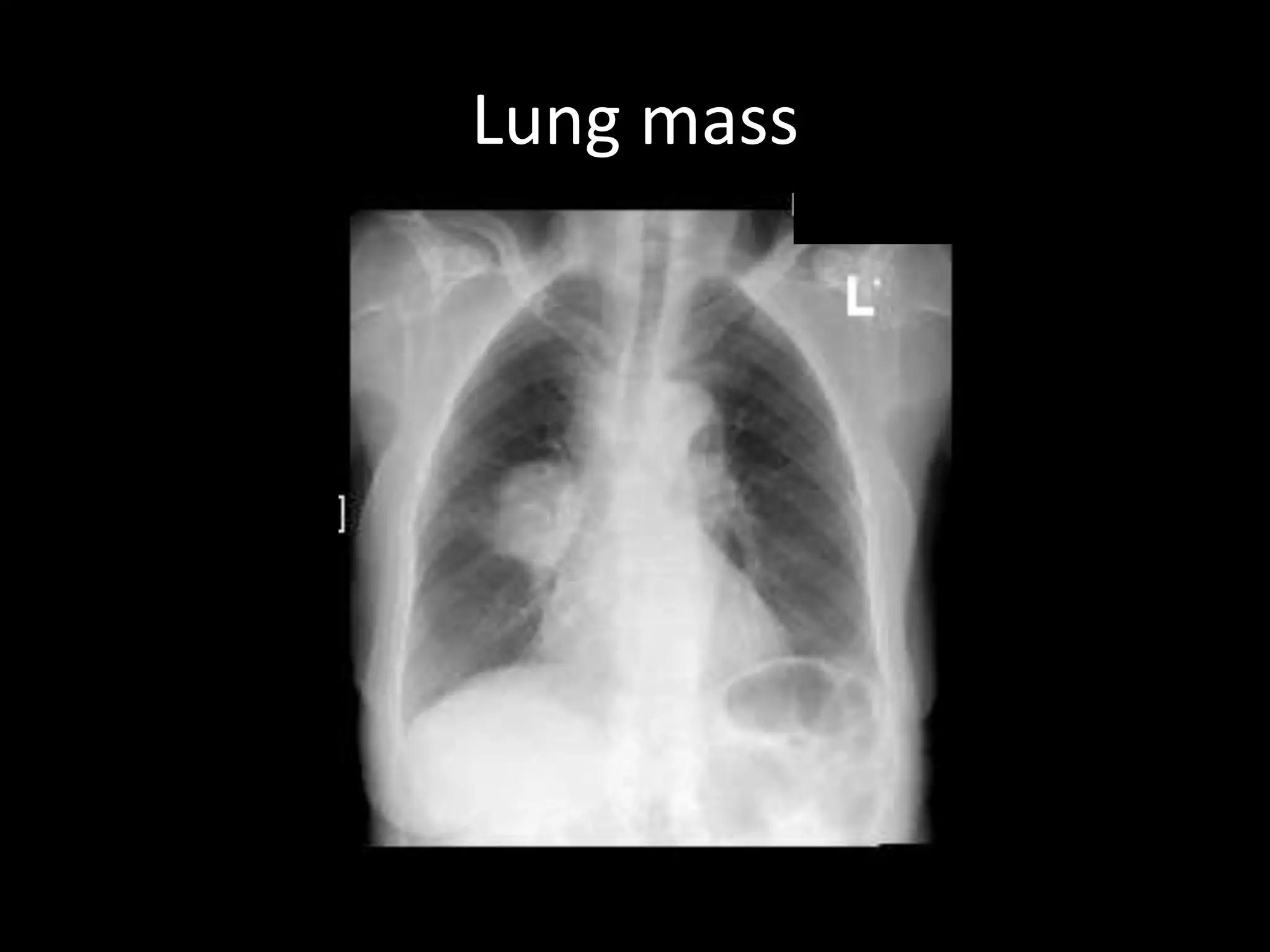 Chest X-ray Interpretation | PDF