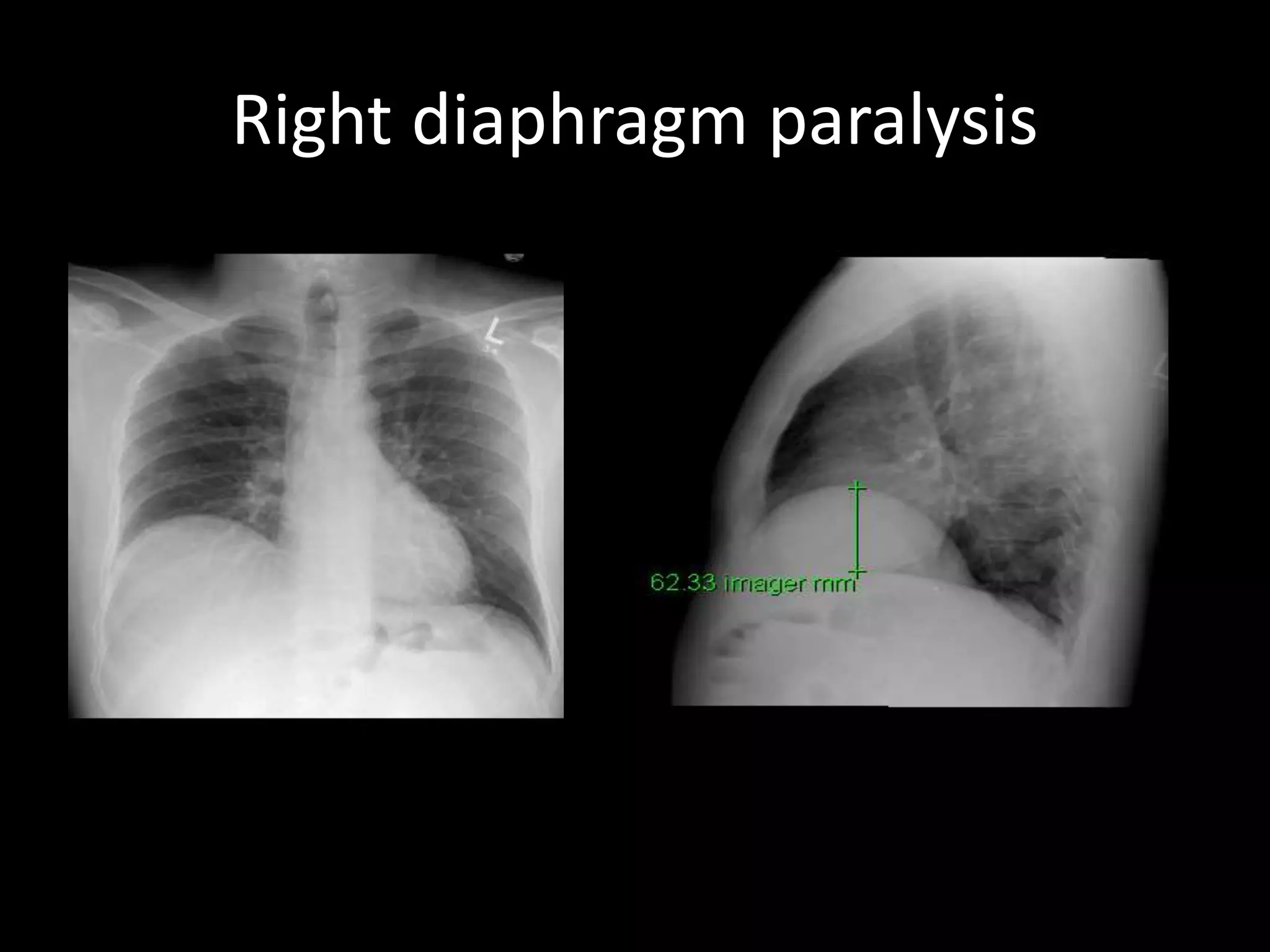 Chest X-ray Interpretation | PDF
