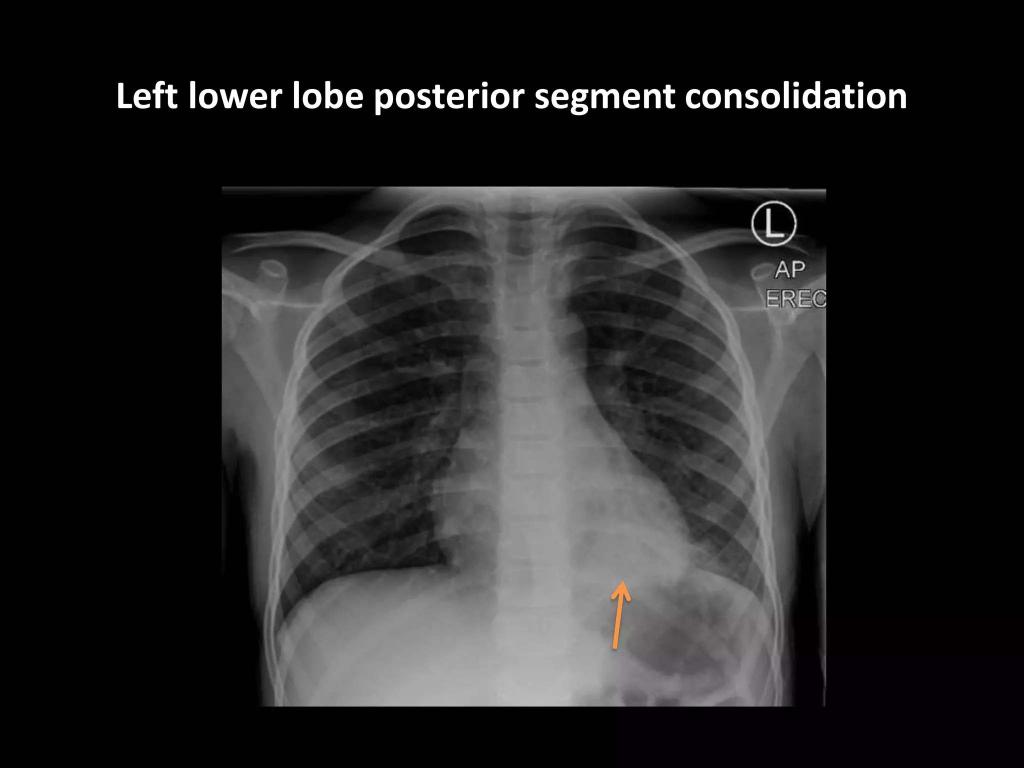 Chest X-ray Interpretation | PDF