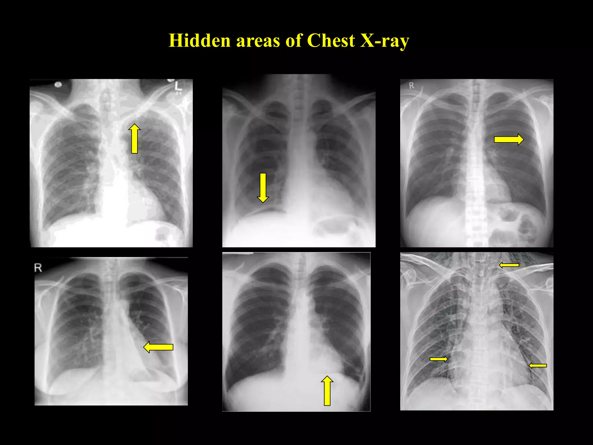 Chest X-ray Interpretation | PDF