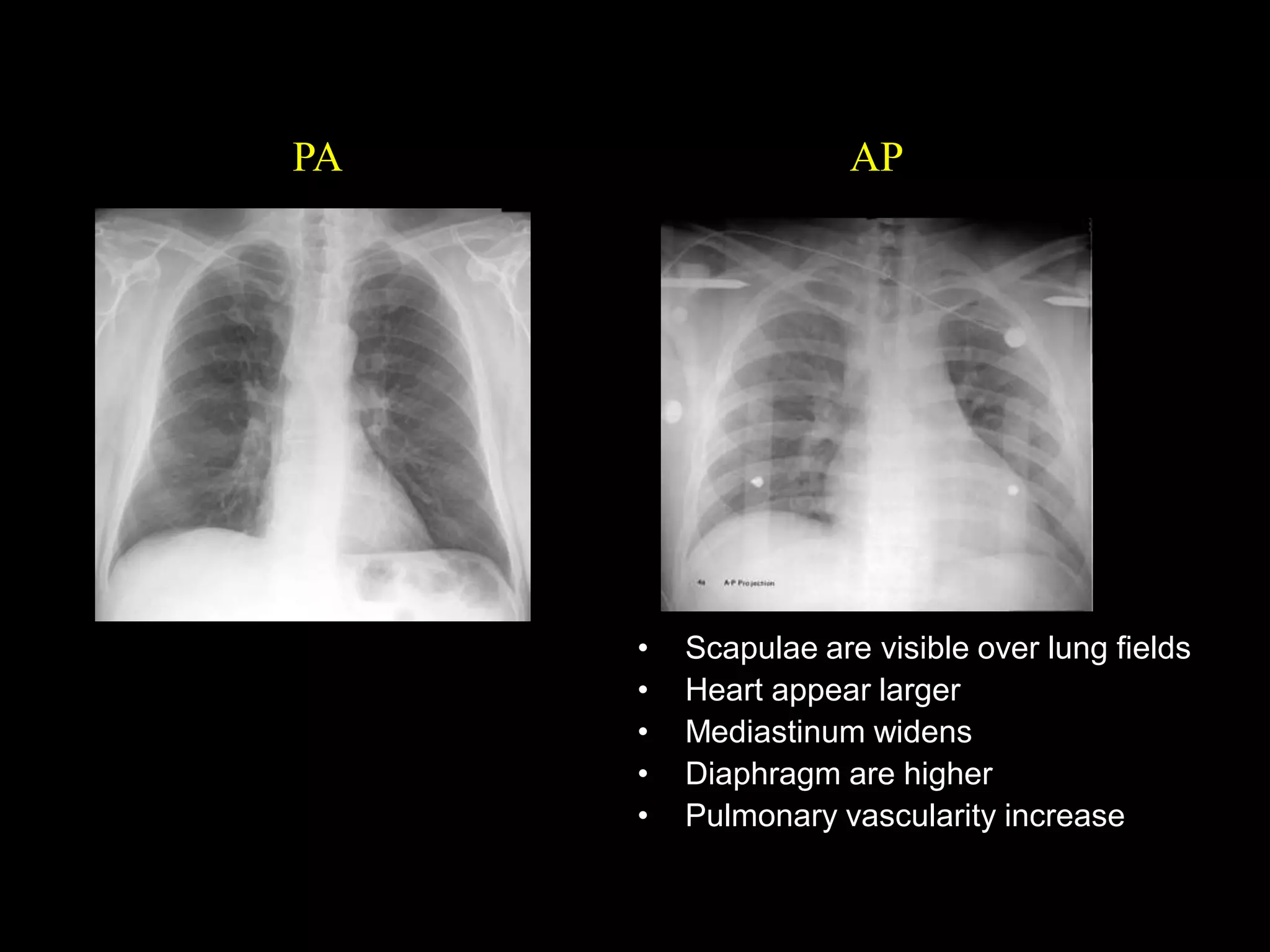 Chest X-ray Interpretation | PDF