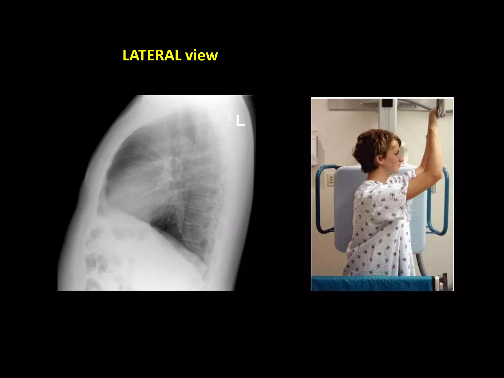 Chest X-ray Interpretation | PDF