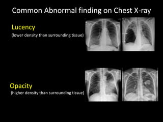 Chest X-ray Interpretation | PDF