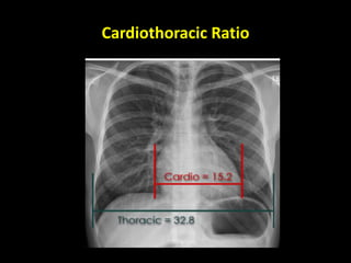 Chest X-ray Interpretation | PDF