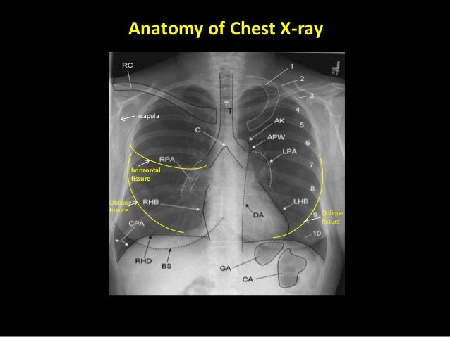 Chest X-ray Interpretation