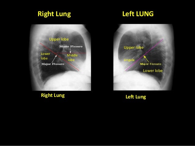 Chest X-ray Interpretation