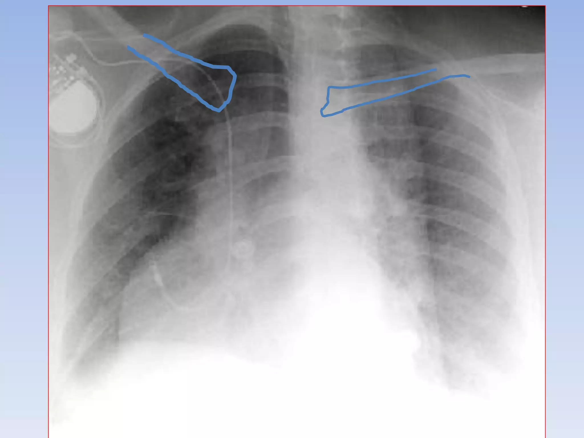 Chest x ray Interptetations | PPT