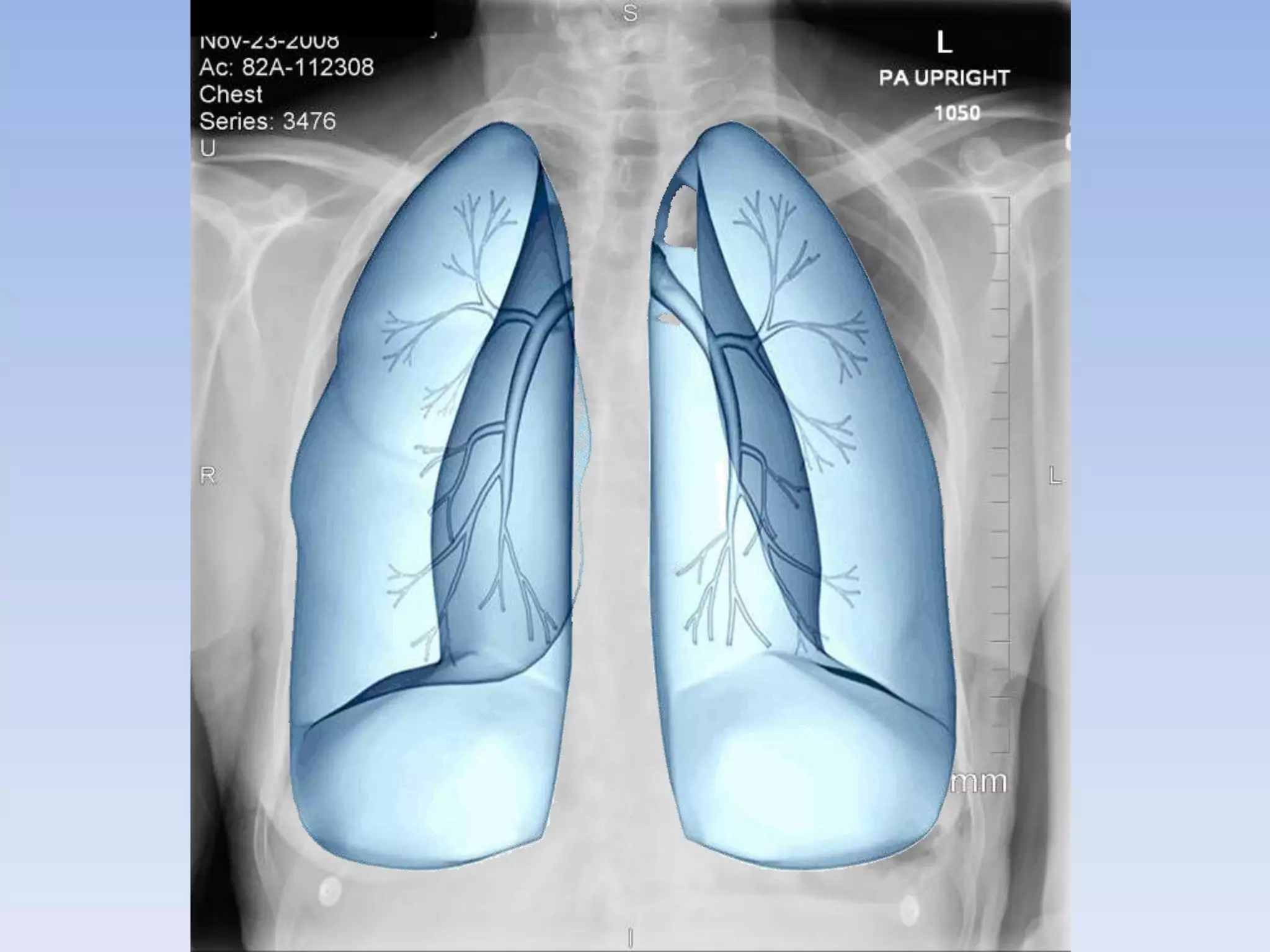 Chest x ray Interptetations | PPT