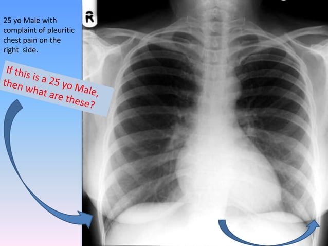 Chest x ray Interptetations | PPT