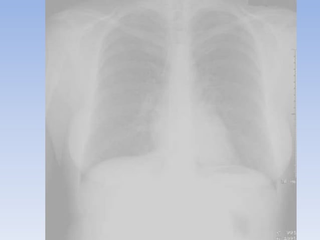 Chest x ray Interptetations | PPT
