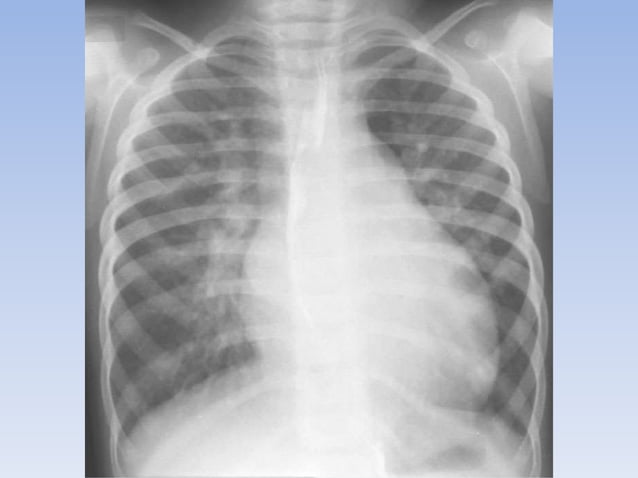 Chest x ray Interptetations | PPT