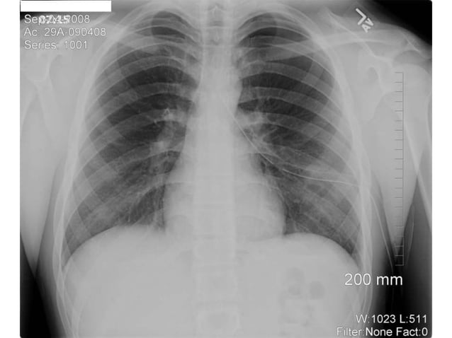 Chest x ray Interptetations | PPT