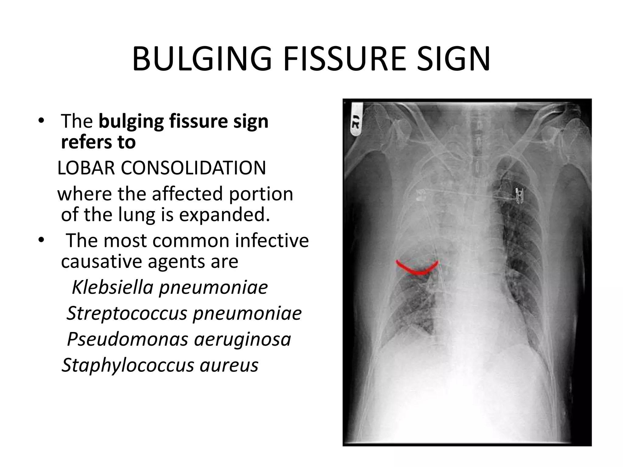 CHEST X-RAY.PPT.pptx