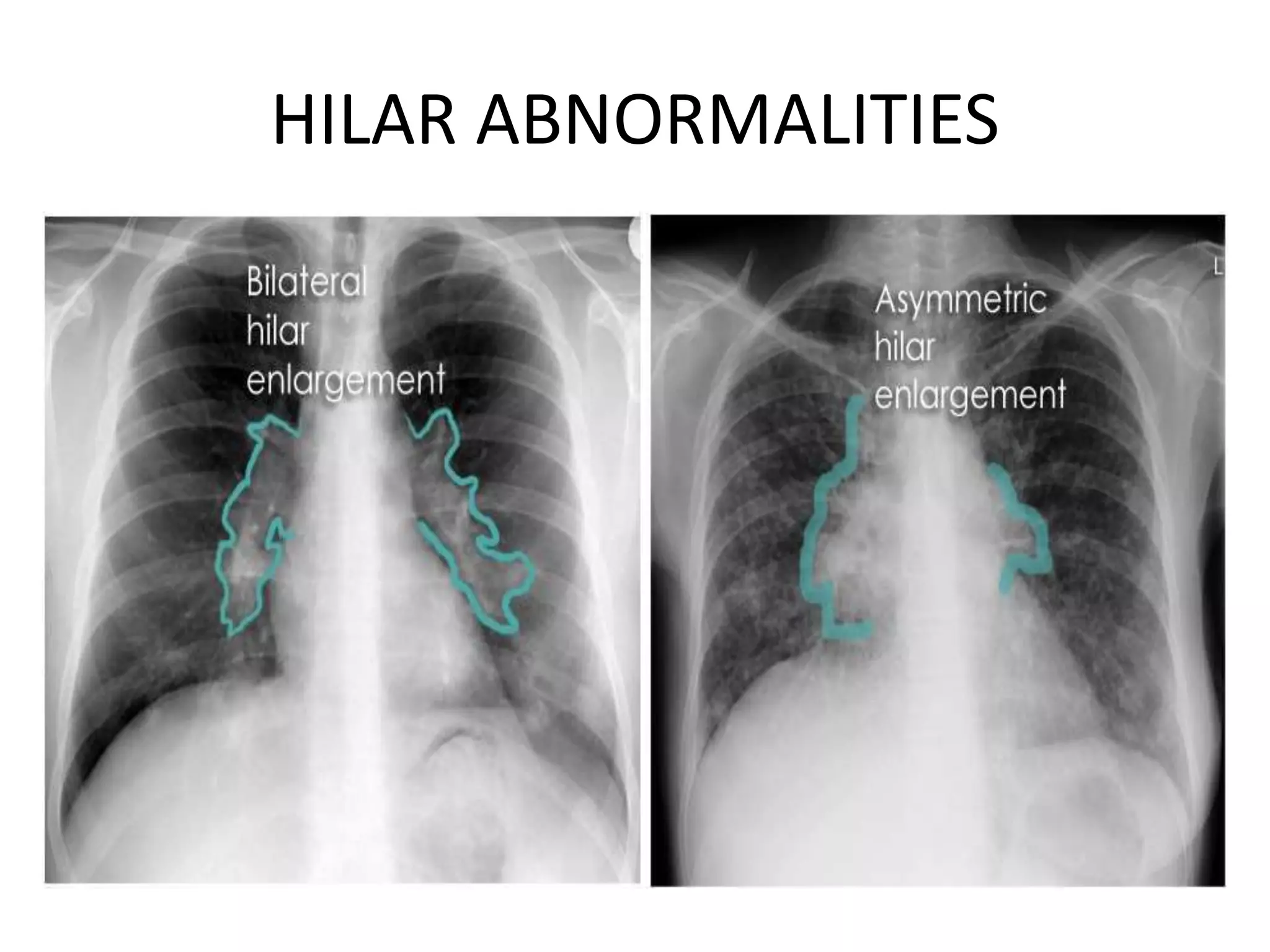 CHEST X-RAY.PPT.pptx