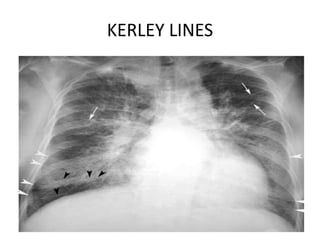 CHEST X-RAY.PPT.pptx