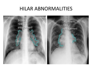 CHEST X-RAY.PPT.pptx