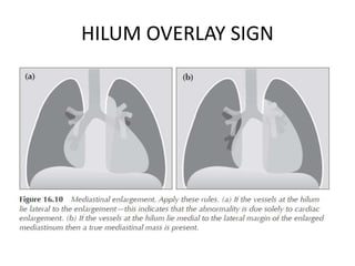 CHEST X-RAY.PPT.pptx