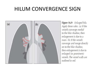 CHEST X-RAY.PPT.pptx