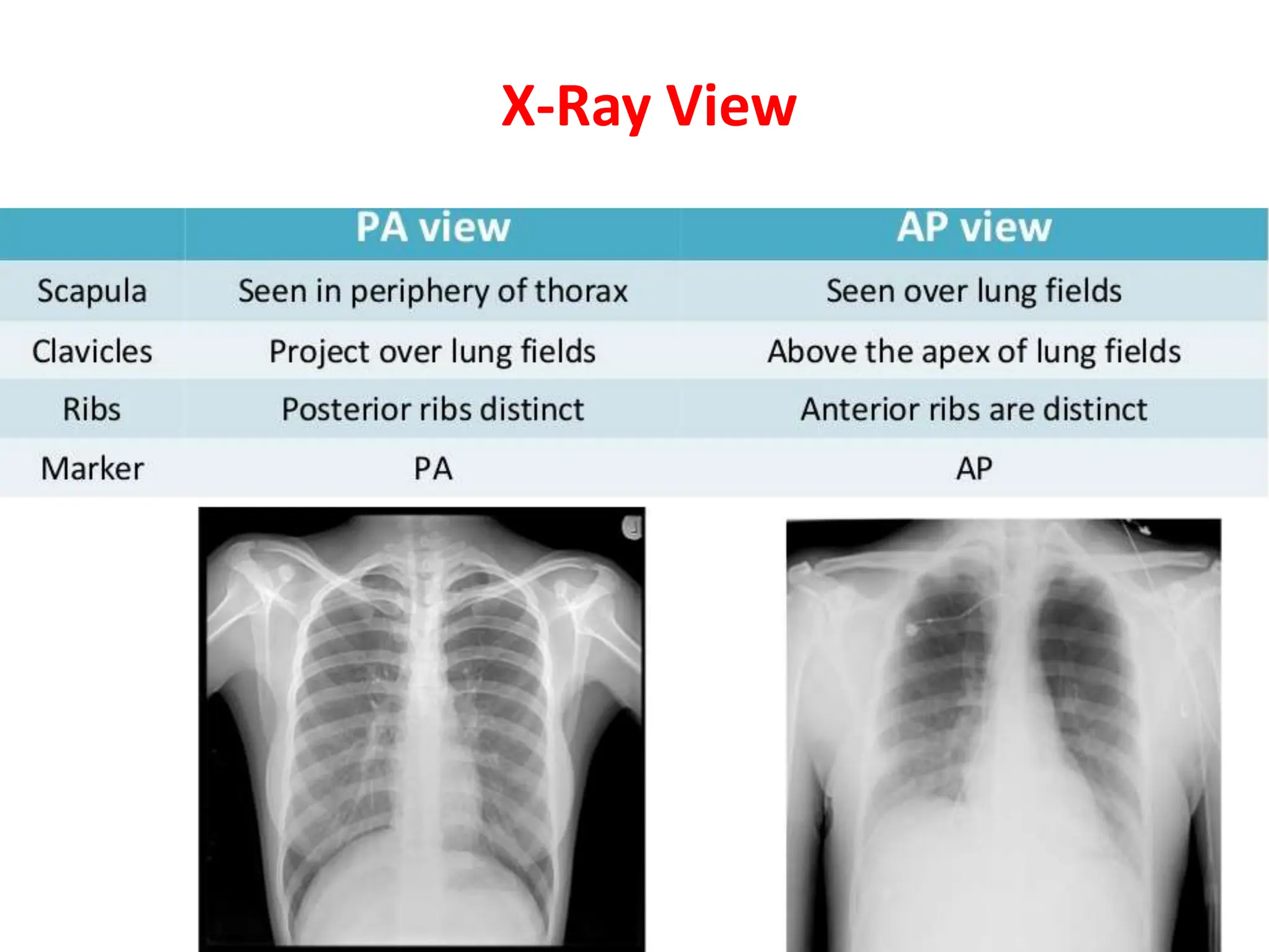Understanding and Reading of Chest X-Rays | PPTX